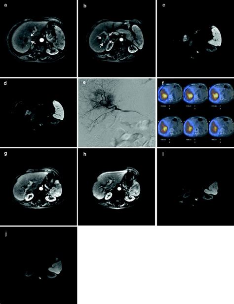 Radiology Management Of Unresectable Intrahepatic Cholangiocarcinoma