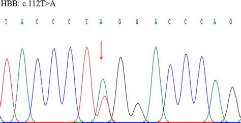 Sanger Sequence Identified Heterozygosity For A Mutation Of The Download Scientific Diagram