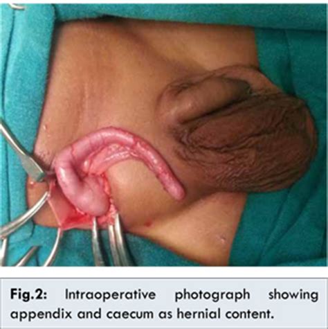 Real Appendix
