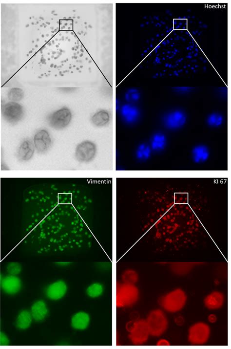 Generation Of Tumor Cell Spheroids In Miniaturized Nanoliter Droplets