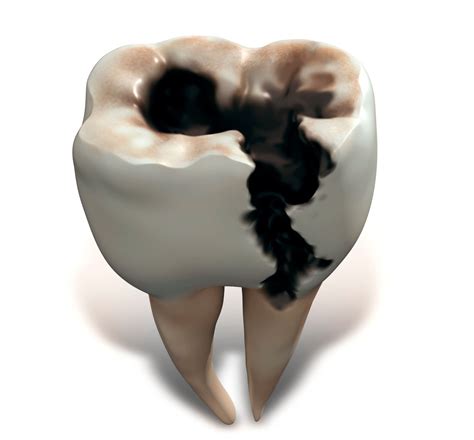 What Causes A Decayed Wisdom Tooth And How Is It Treated