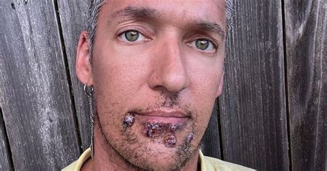 Adult Film Star Tests Positive For Monkeypox Shares Scary Symptoms