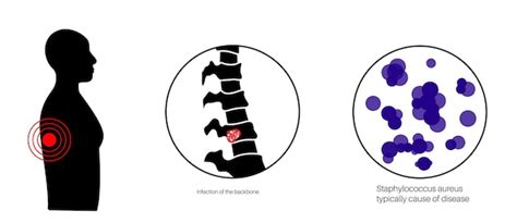 Premium Vector Vertebral Osteomyelitis Infected Spine Bones