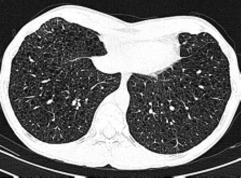 Posteroanterior Chest Radiograph Linear And Reticulonodular Download Scientific Diagram