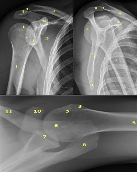 Radiology Shoulder X Ray 2 Diagram Quizlet