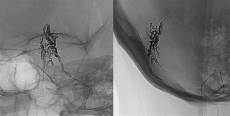 Tentorial Dural Fistula Hybrid Double Angle And Scepter Mini Embolization