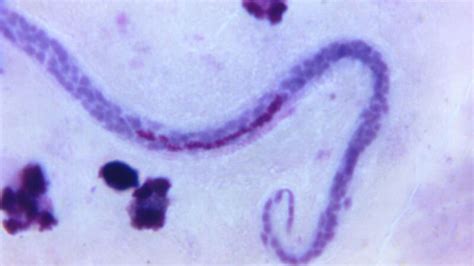 Parasitic Worms Twirl And Dance In A Mans Scrotum Gadgetany