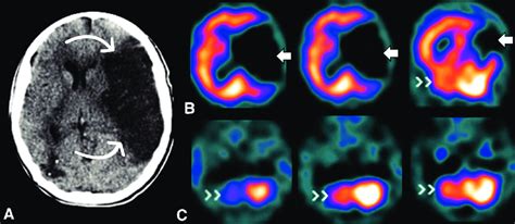 Right Crossed Cerebellar Diaschisis A An Axial Ct Image Showing A