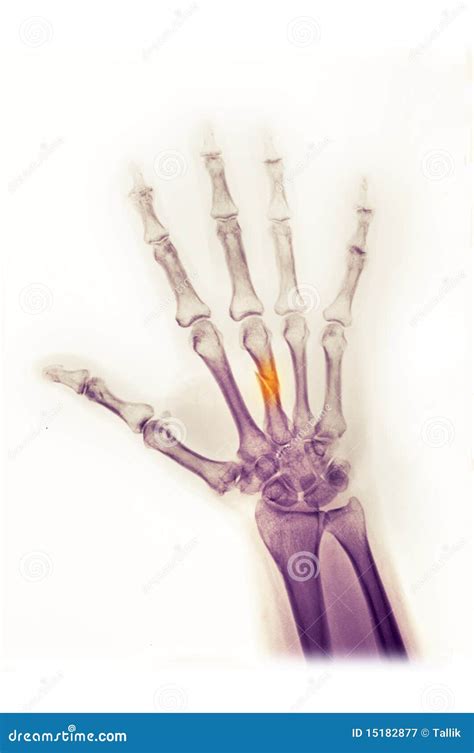 Hand X Ray Fractured Metacarpal Stock Image Image Of Medicine