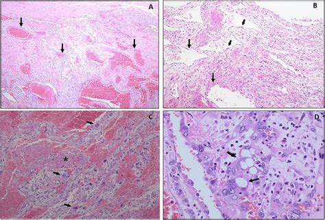 Histopathology Of Symplastic Hemangioma Showing A Well Defined