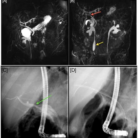 [a] Magnetic Resonance Cholangiopancreatography Mrcp Before Initial Download Scientific