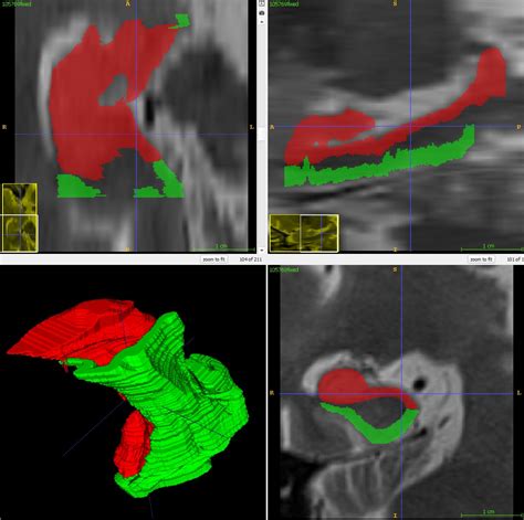 New Itk Snap Features Improve Segmentation