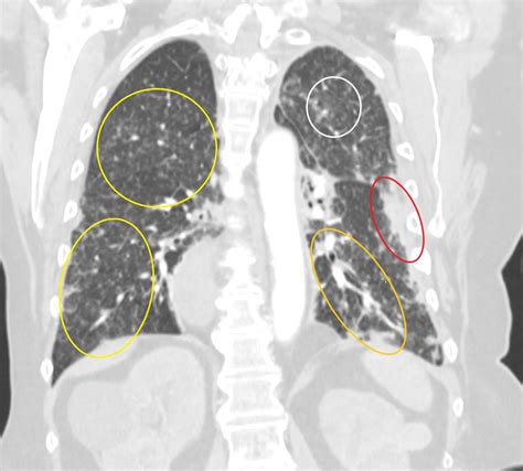 B76782 01 Lungs Diffuse Micronodules Subpl Consolid Ggo Bronchovasc Thickening Drug Induced