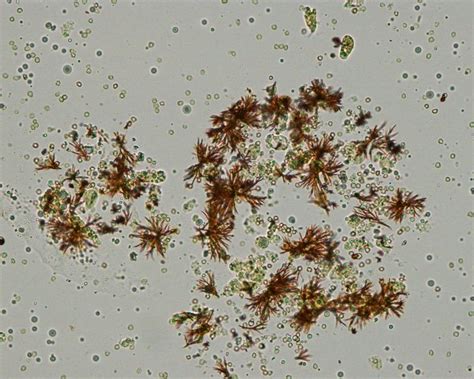 Types Of Crystals In Urine