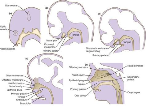 Choanal Atresia Clinical Features And Treatment