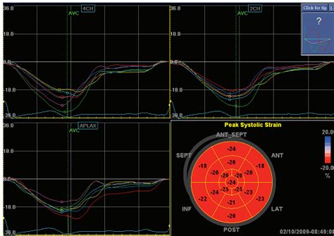 Afi Automated Function Imaging Strain Longitudinal Segmentaire Et