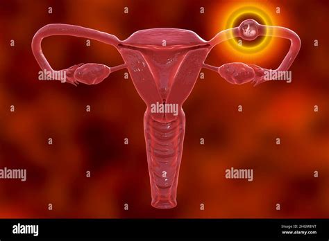 Ectopic Pregnancy Illustration Stock Photo Alamy