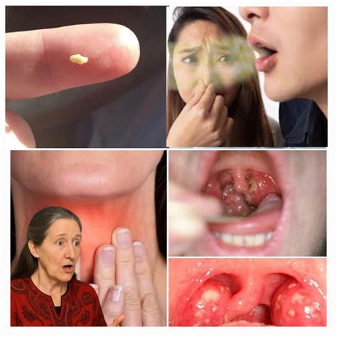 ГОО Мэдээлэл Амнаас эвгүй үнэр гарах шалтгаан ходоодны өвчин байж болно үүнийг эход харуулж