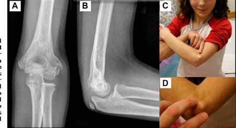 Lateral Epicondyle Fracture