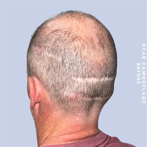 Hair Restoration Before And After Photos Dr Hardik Doshi