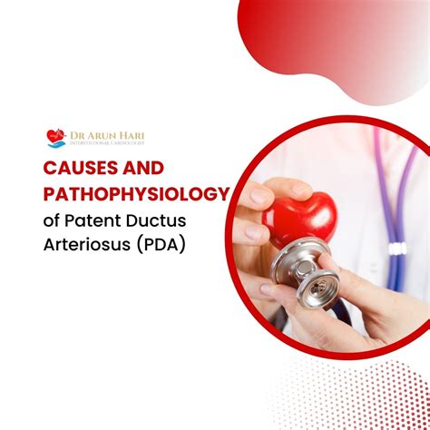 Dr 🫀 Understanding Patent Ductus Arteriosus Pda A Congenital Heart Concern Pda Is A