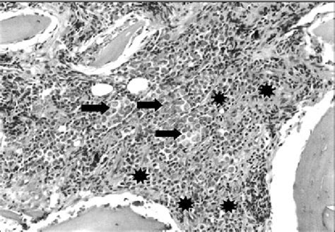 The Bone Marrow Is Diffusely Replaced By Two Populations Of Cells Download Scientific Diagram