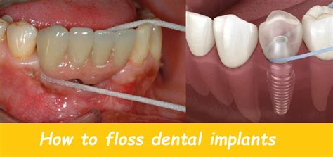 How To Floss Dental Implants