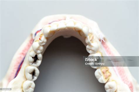 연구 진단 캐스트 및 치과 실험실에서 치과 석고 모델의 캐스팅 개방교합에 대한 스톡 사진 및 기타 이미지 개방교합 건강 진단 건강관리와 의술 Istock