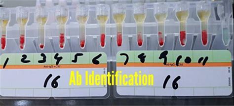 Gel Card Showing Positive And Negative Results 11 Cell Panel