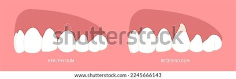 Abscess Pericoronal Over 11 Royalty Free Licensable Stock