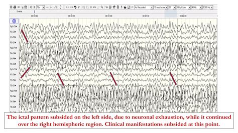 Eeg In Convulsive And Non Convulsive Seizures In The Intensive Care