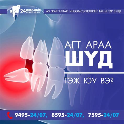 Агт араа шүд гэж юу вэ Шүдний мэргэжлийн салбарынхан агт арааг ихэнхдээ гуравдугаар их араа