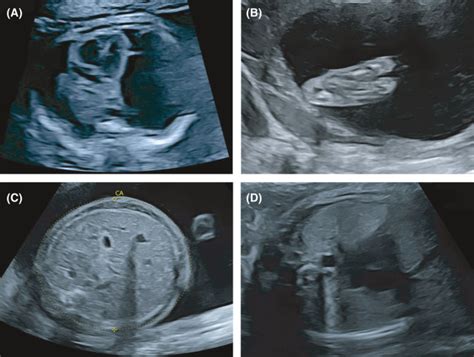 Spontaneous Resolution Of Nonimmune Hydrops Fetalis In A Fetus With