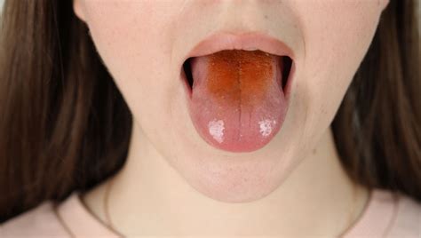 Qué Ocurre Si Tengo La Lengua Amarilla
