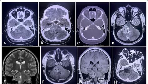 Radiological Images A An Axial Ct Brain Revealing A Right Hypodense
