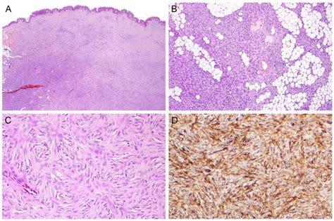 Rare Variants Of Dermatofibrosarcoma Protuberans Clinical Histologic And Molecular Features