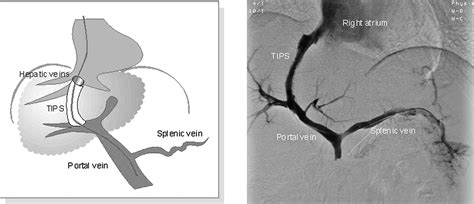 What Is Tips Procedure For Ascites At Indiana Townson Blog