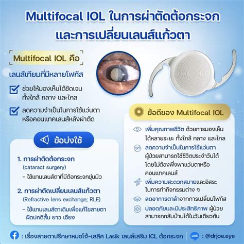 Multifocal Iol The Solution For Sharp Vision At Any Distance