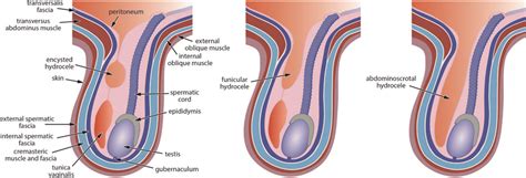 Diagram Illustrates The Classification Of Congenital Hydroceles Left