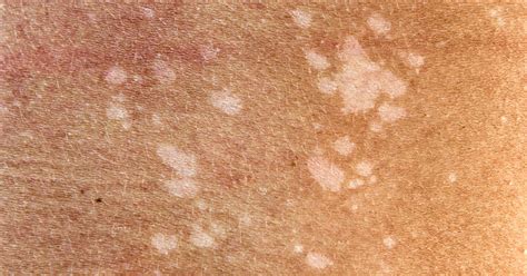 Guide To The Conditions That Cause Hypopigmentation