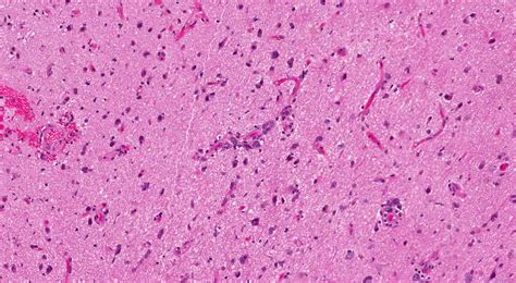 Primary CNS Diffuse Large B Cell Lymphoma Ottawa Atlas Of Pathology