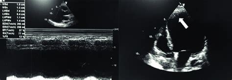 Echocardiographic Findings Six Months After Icd Crt Implantation Download Scientific Diagram