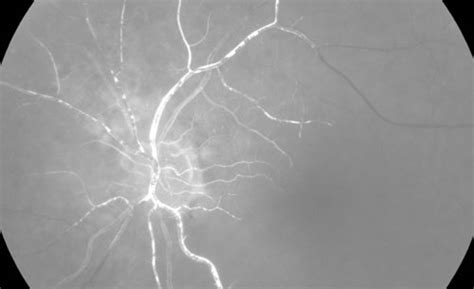 Retinal Ischemia
