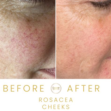 Ipl For Vascular Lesions Downtime And Recovery Time Luxe Appearance