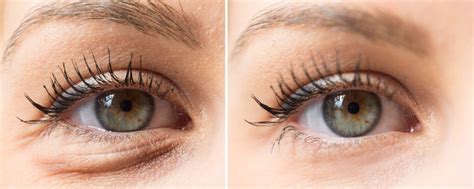 Get Amazing Upper Eyelid Sagging Today Royal Dental Clinics Blog