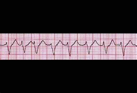 2 Cases Of Arrhythmogenic Syncope In Adolescents