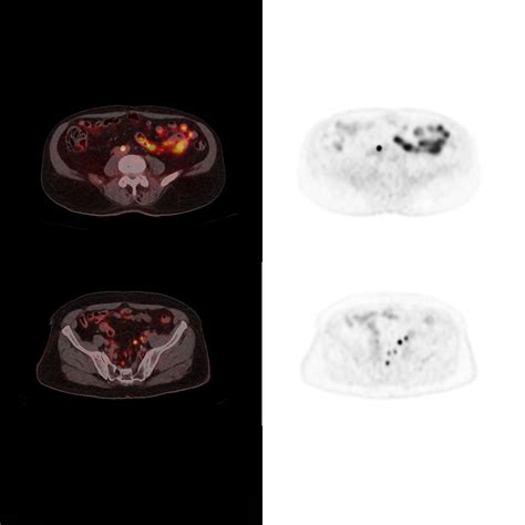 Body Cartesion Prime Clinical Gallery Molecular Imaging Canon Medical Systems Usa