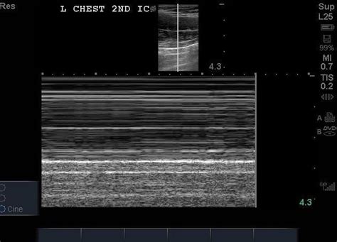 Diagnosing Pneumothorax With Bedside Ultrasound — Nuem Blog