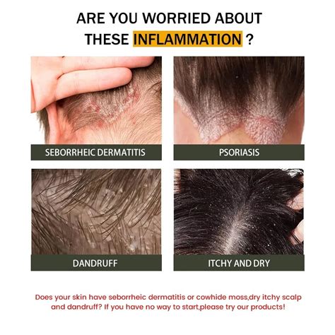 Eczema On Scalp Seborrheic Dermatitis Cream Eczema Scalp Skin Ointment