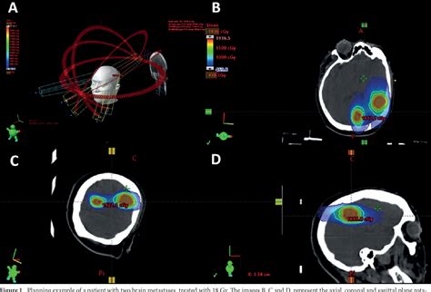Figure 1 From Volumetric Modulated Arc Radiosurgery For Brain Metastases From Breast Cancer A